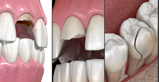 Traumatismele dentare – De la „au” la rezolvare